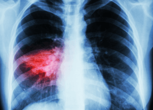 Understand Chest Infections: Symptoms and Causes - Medmate